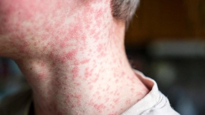 CDC warns of measles risk at airports and on flights, urges vaccination ...