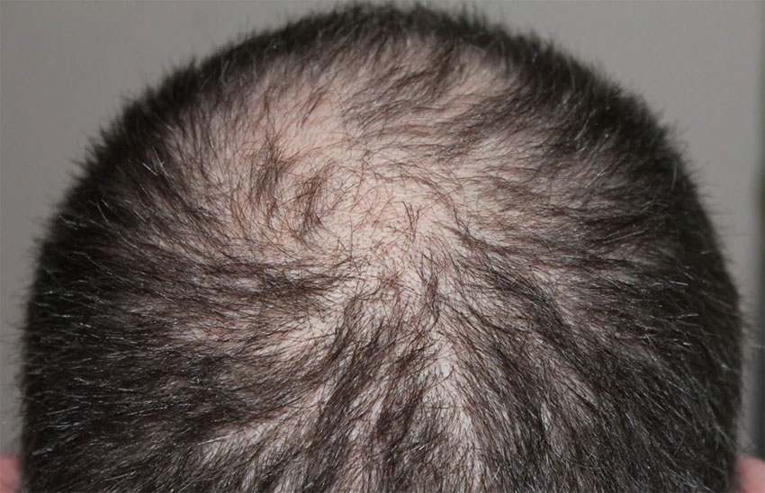 Hair loss common symptom after COVID-19 infection | arabtimes